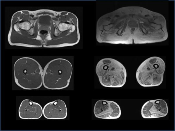 Getting diagnosed with a muscle wasting condition - Muscular Dystrophy UK
