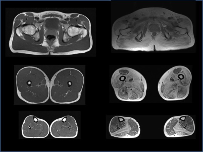Getting diagnosed with a muscle wasting condition - Muscular Dystrophy UK